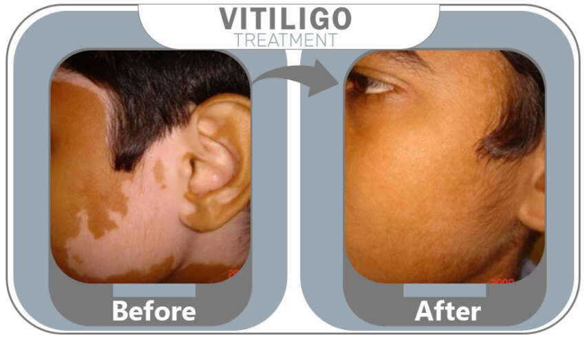 Vitiligo Treatment – Dr. Shruti – Best Dermatologist in Gurgaon